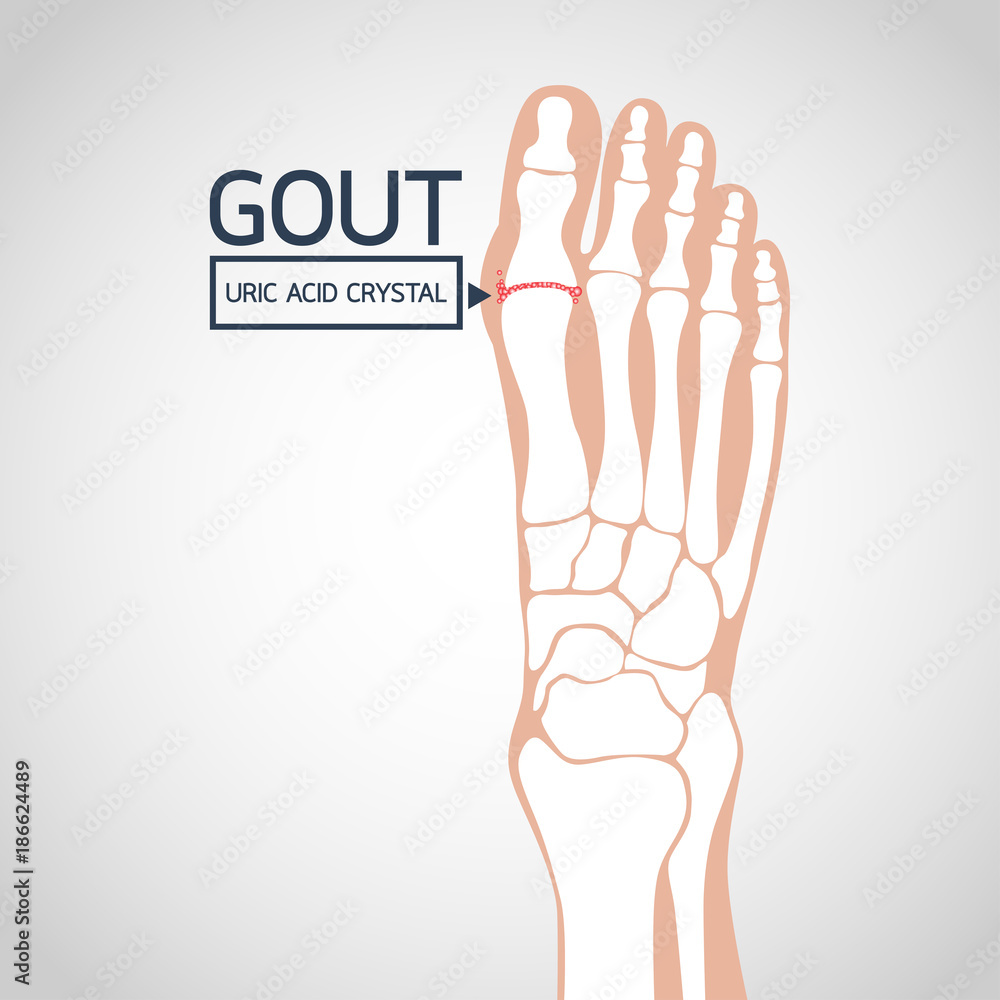 Gout vector logo icon illustration Stock Vector | Adobe Stock