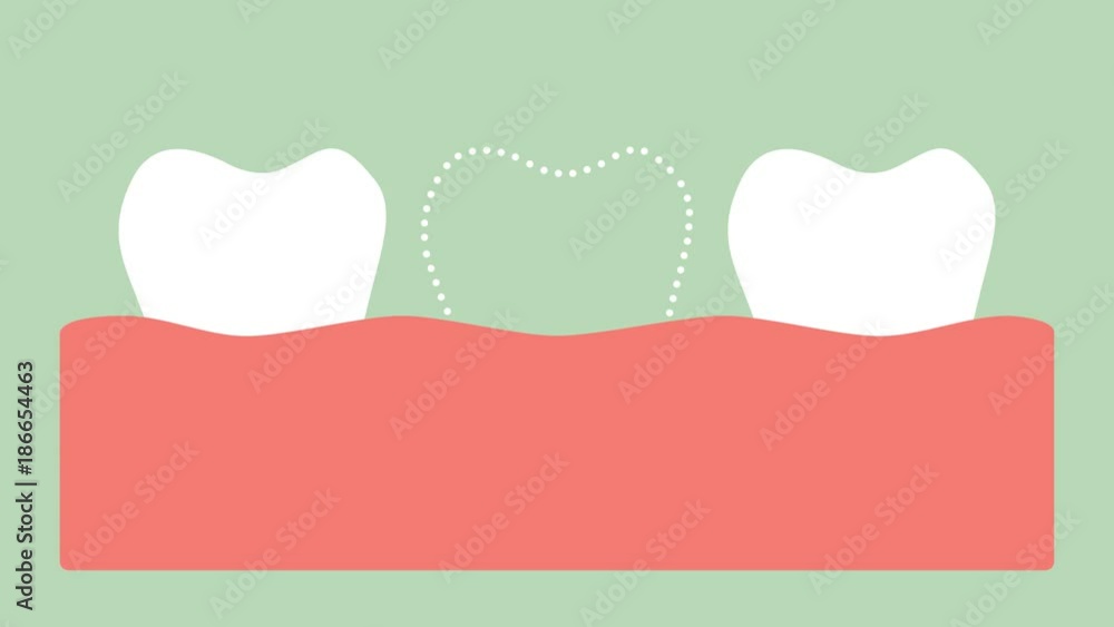 missing tooth, space in mouth - dental cartoon 2d animation in 4K Stock ...