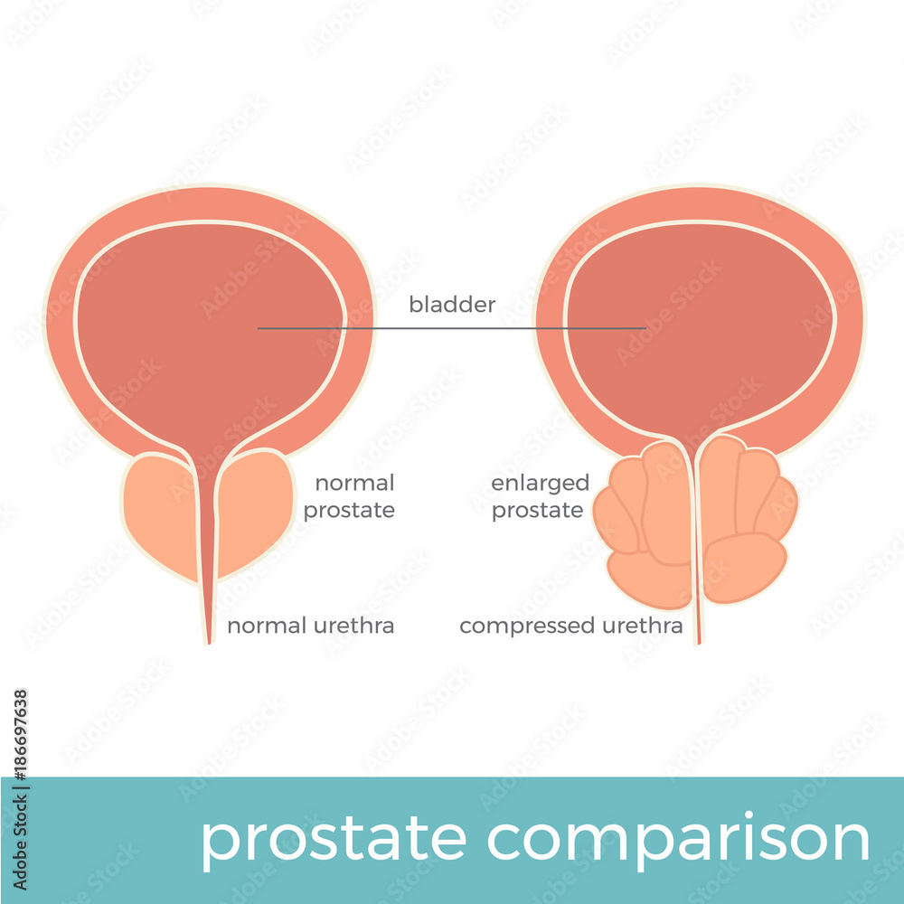 vector illustration of normal and enlarged prostate comparison vector ...