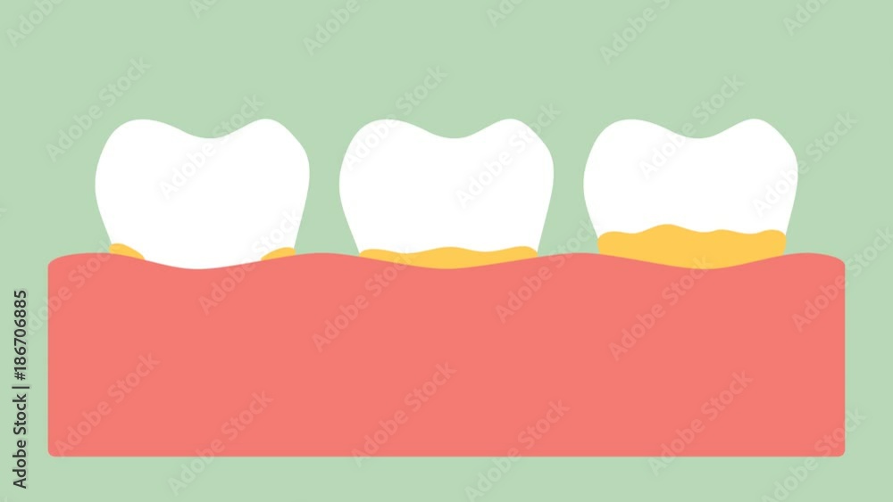 plaque on gum before gingivitis or gum disease - dental cartoon 2d ...