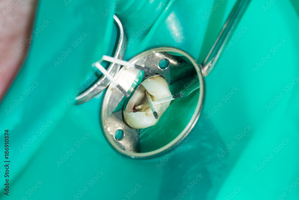 caries treatment of a tooth close up using the Rubber Dam system and ...