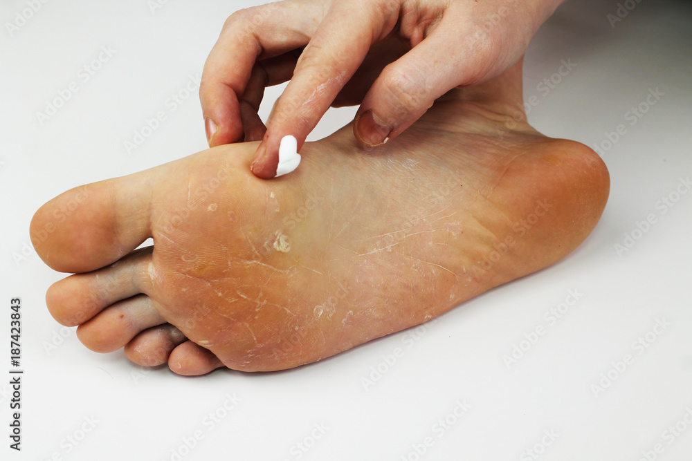 Fungus of foot close-up, isolated on white background. The concept ...