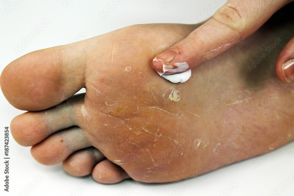 Fungus of foot close-up, isolated on white background. The concept ...