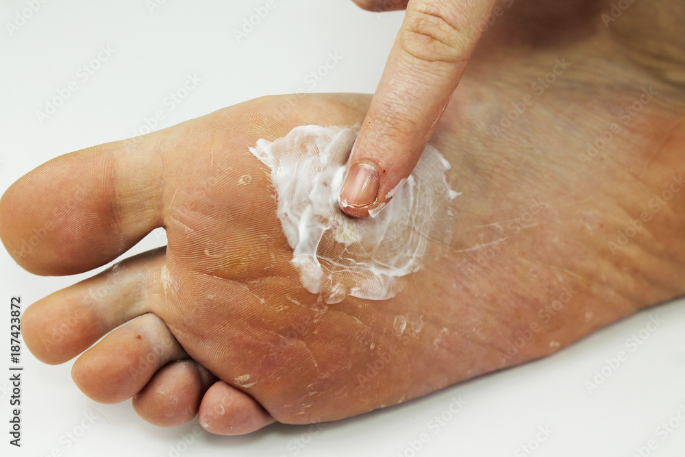 Fungus of foot close-up, isolated on white background. The concept ...