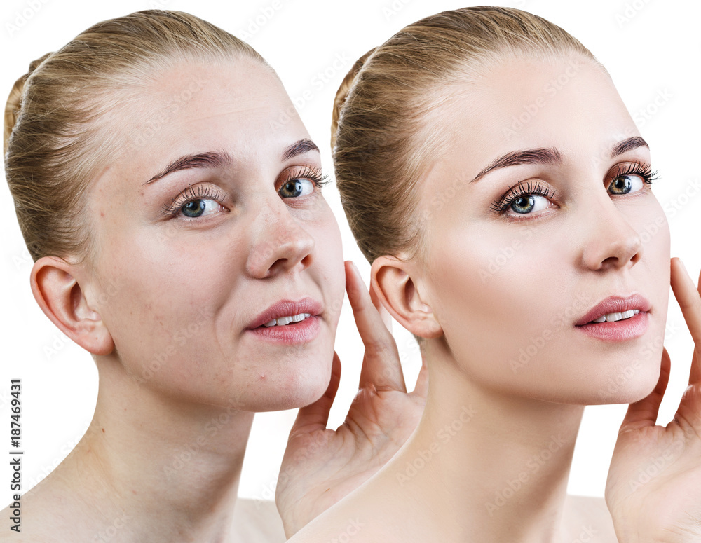 Woman's face before and after rejuvenation. Stock Photo | Adobe Stock