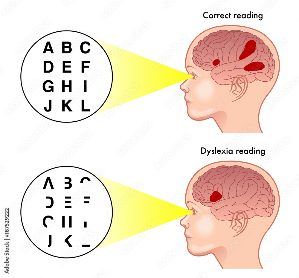 medical illustration of the symptoms of dyslexia Stock Vector | Adobe Stock