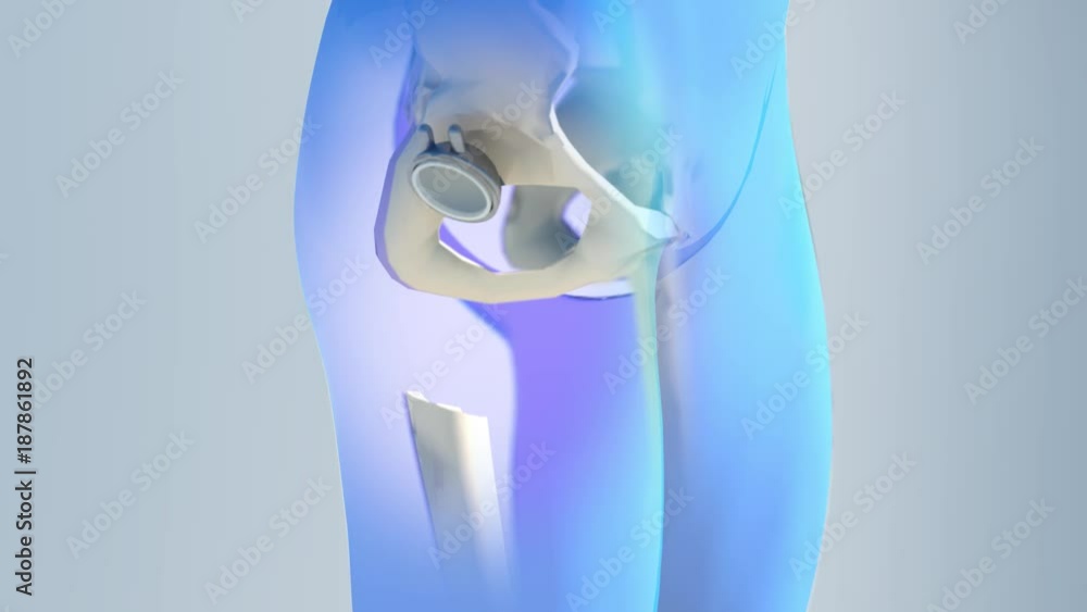 Hip replacement implant installed in the pelvis bone. Medically ...