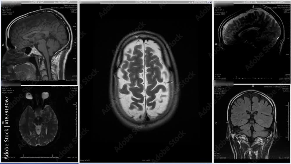 Grid of MRI brain images with looping central panel view from top to ...