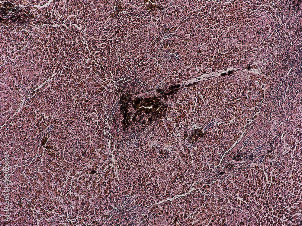 Human Pathology - Pigmentary cirrhosis of liver - Abnormal alterations ...