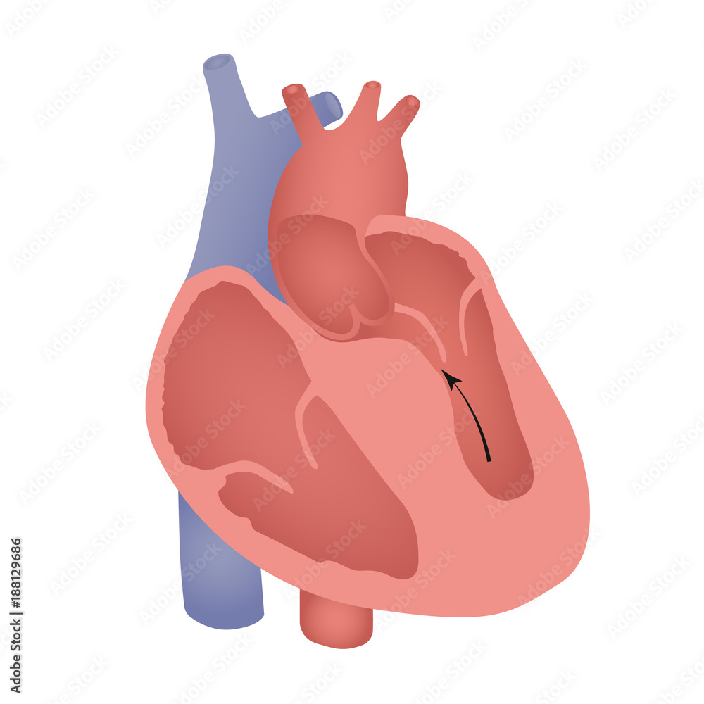 Obstructive hypertrophic septal cardiomyopathy illustration Stock ...