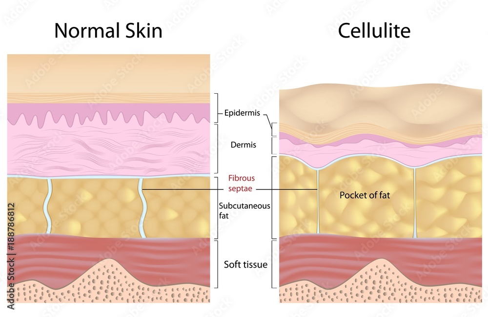 Cellulite versus smooth skin, labeled Stock Illustration | Adobe Stock