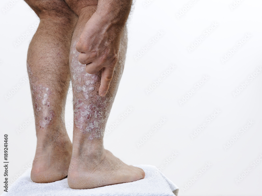 Psoriasis On Legs