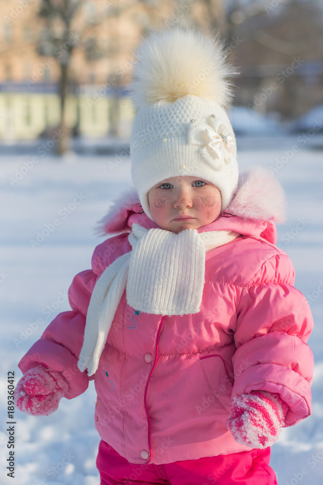 beautiful baby girl with frostbitten face or with allergic rash on ...