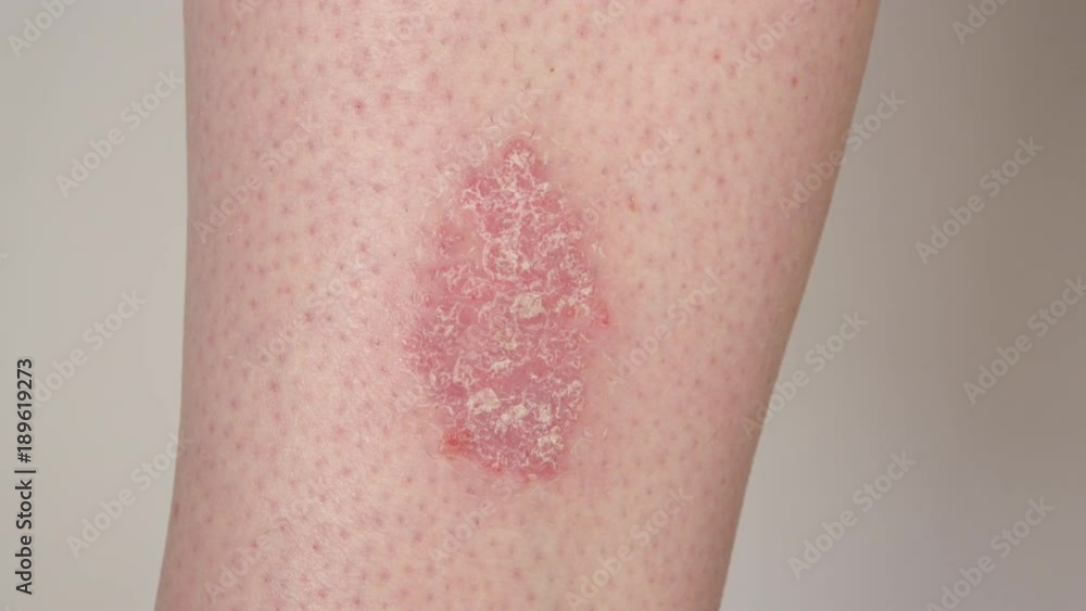 Close Up Detailed Shot Of Pink Hued Patch With Particles Of Itchy Dry Skin Unrecognizable