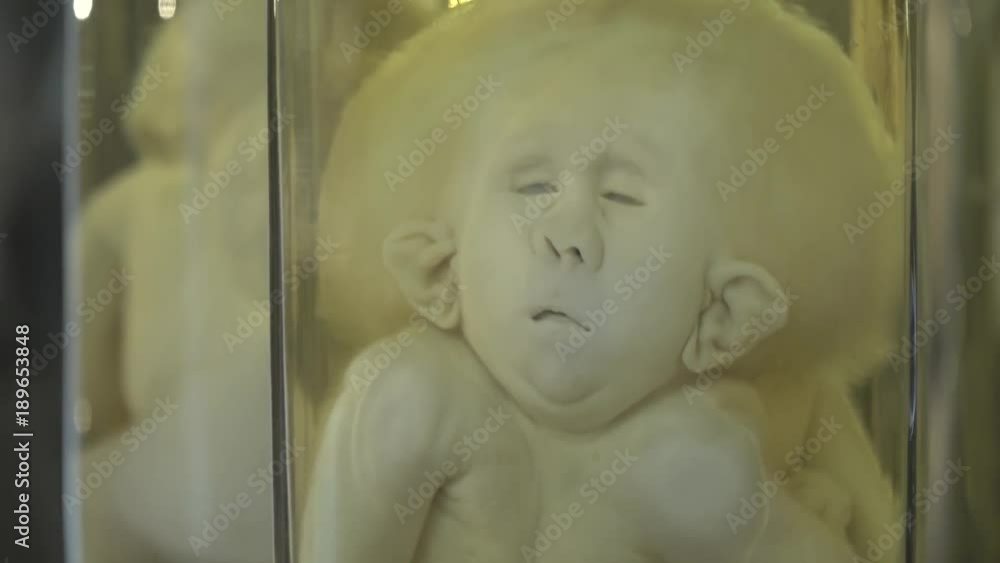 Anatomical preserved human specimens, ugliness, anomalies. Human parts ...