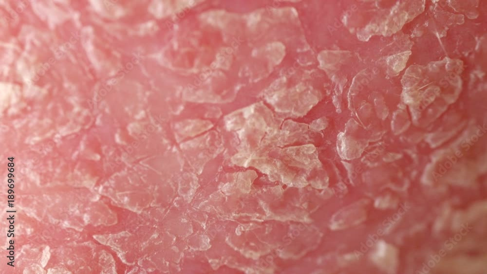 CLOSE UP, MACRO: Detail of dry silver scales covering red inflamed skin ...