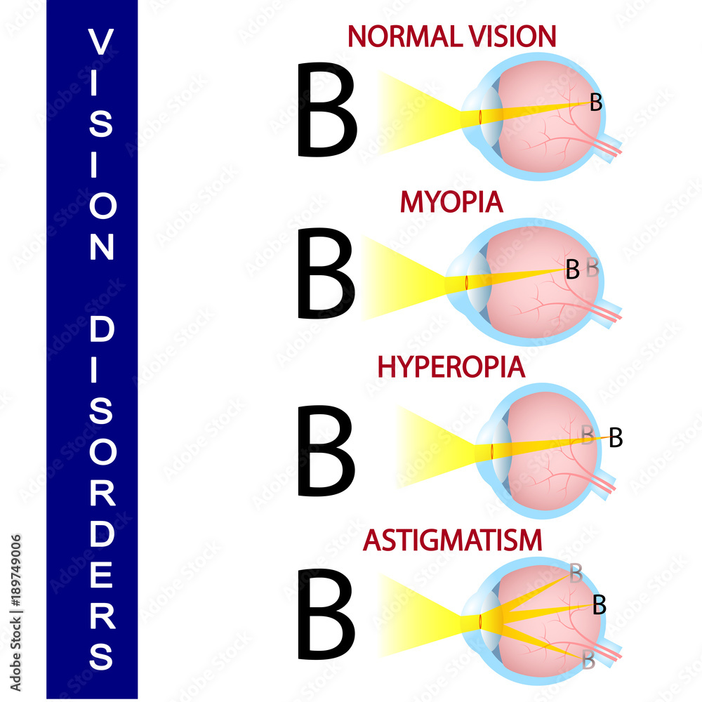 Vision disorders human, science, eye, vision, anatomy, disease, organ ...