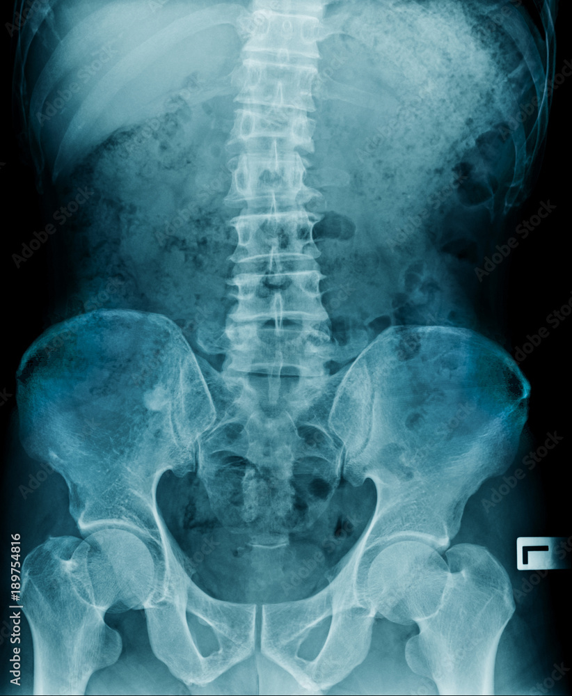 x-ray lower back with pelvic bone show lumbar spondylosis and scoliosis ...