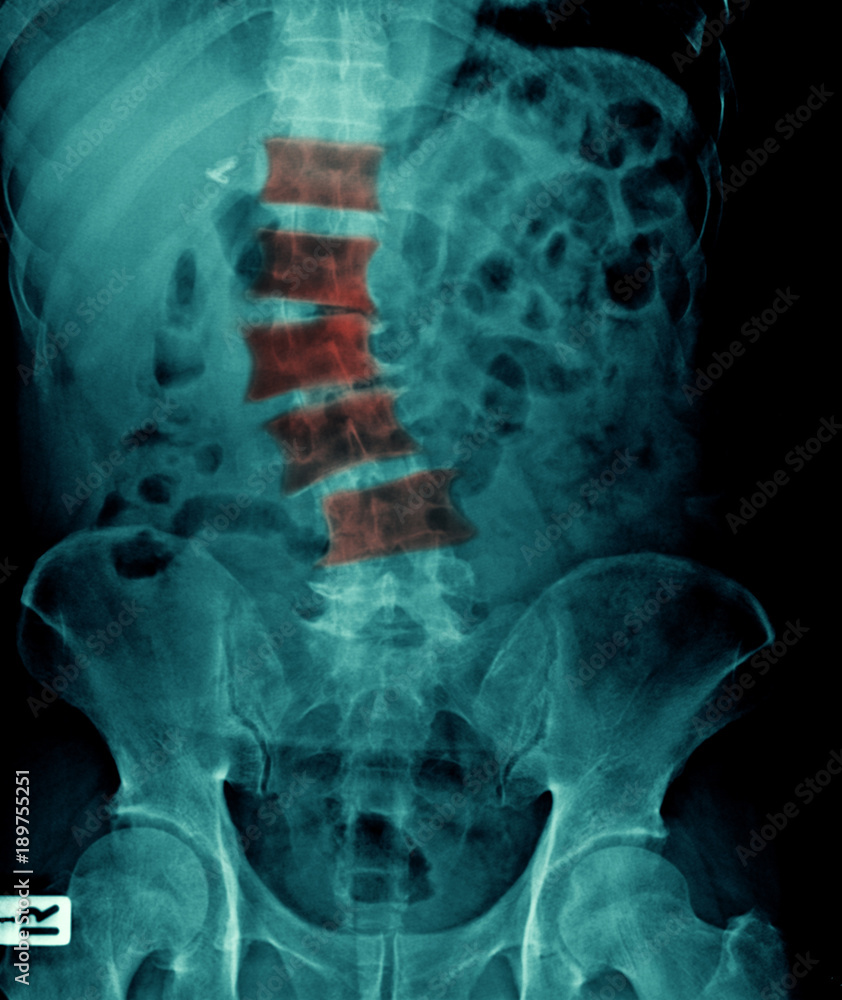 x-ray lower back with pelvic bone show lumbar spondylosis and scoliosis ...