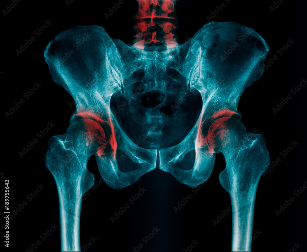 x-ray lower back with pelvic bone show lumbar spondylosis and scoliosis ...
