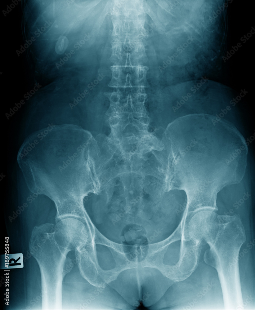 x-ray lower back with pelvic bone show lumbar spondylosis Stock Photo ...