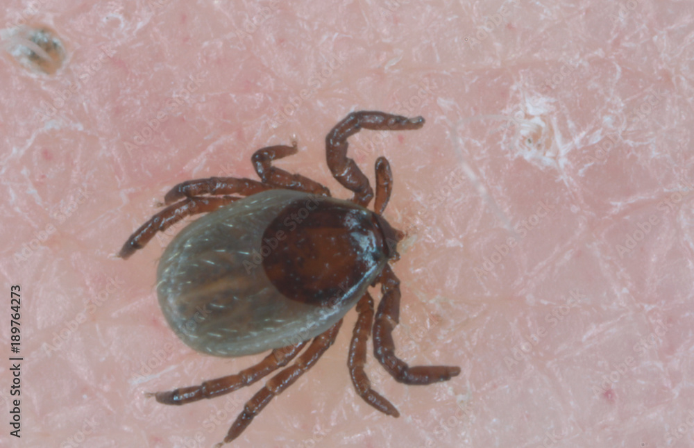 Tick Ixodes ricinus on human skin. tick wandering over human hand ...