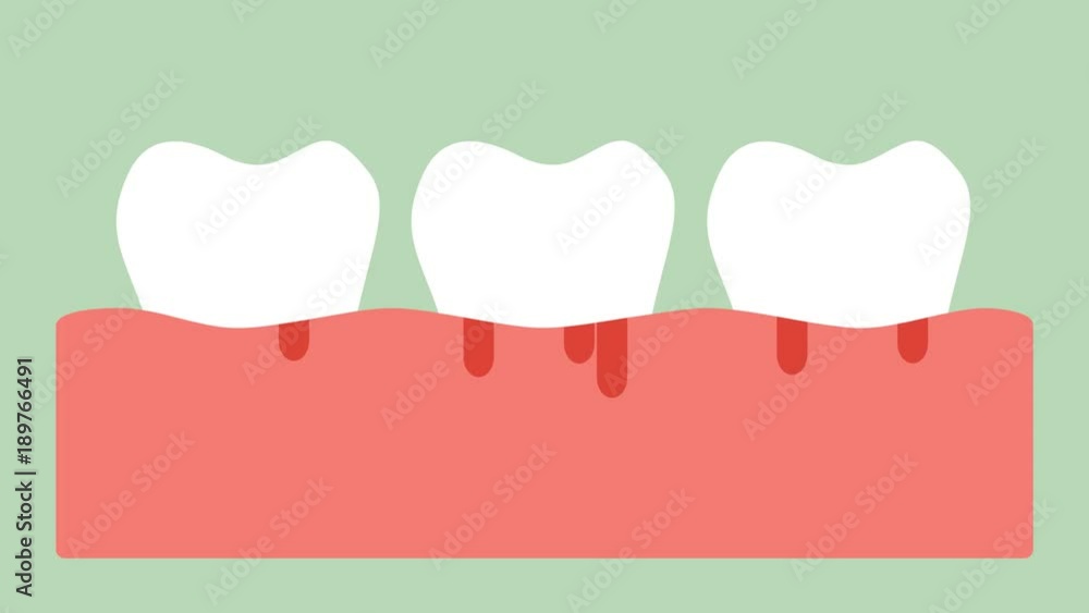 gingivitis or gum disease with bleeding, gum inflammation before ...