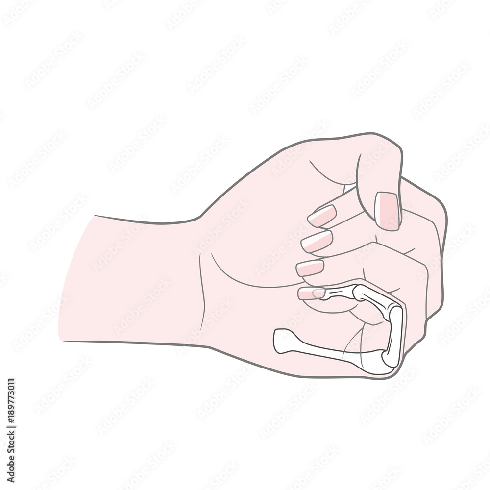 A woman's hand is clenched into a fist. Anatomical image. Metacarpus ...