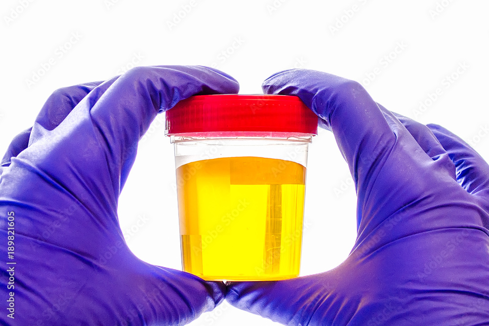 Urine specimen: medical analysis. Urine analysis in the laboratory ...