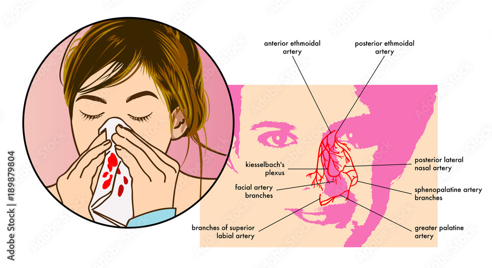 vector medical illustration of the symptoms of epistaxis (nosebleed) Stock Vector | Adobe Stock