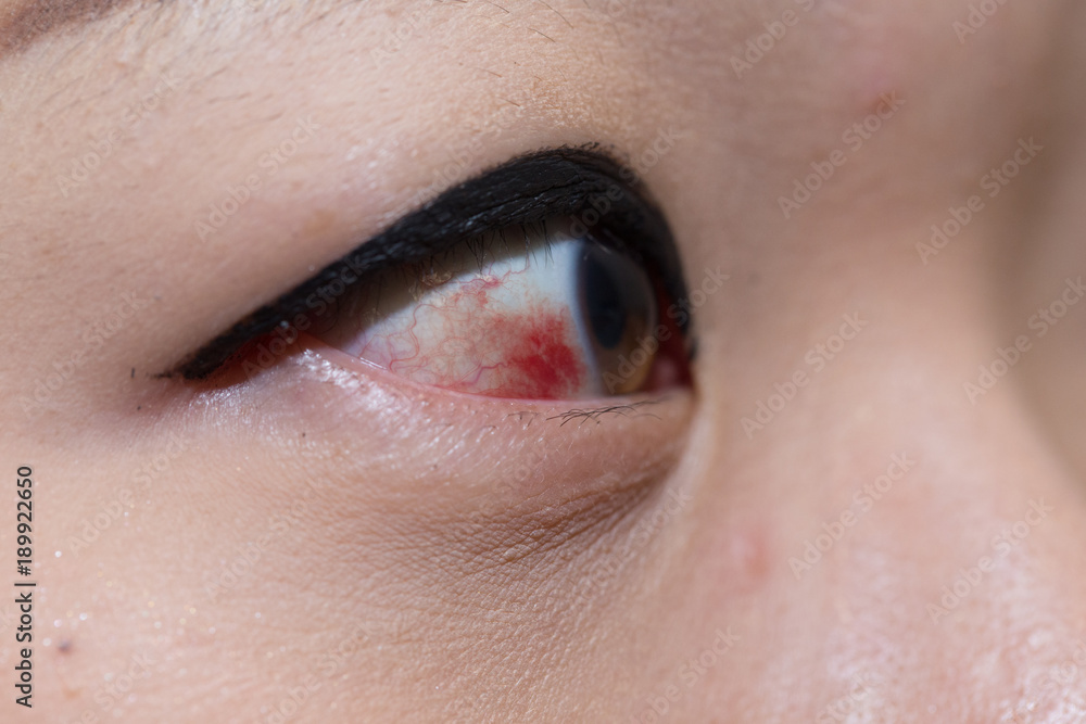 Eye Injured Woman with Subconjunctival Hemorrhage or Broken Blood ...