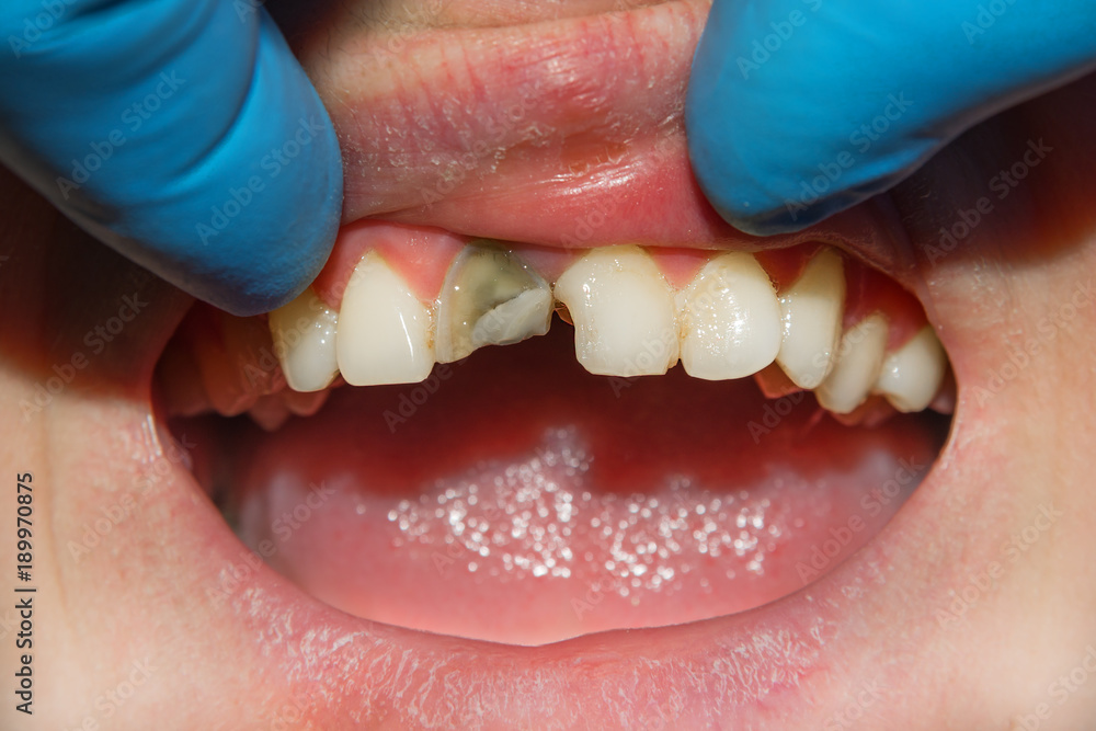 closeup treated human tooth in a dental filling rotten clinic Stock ...