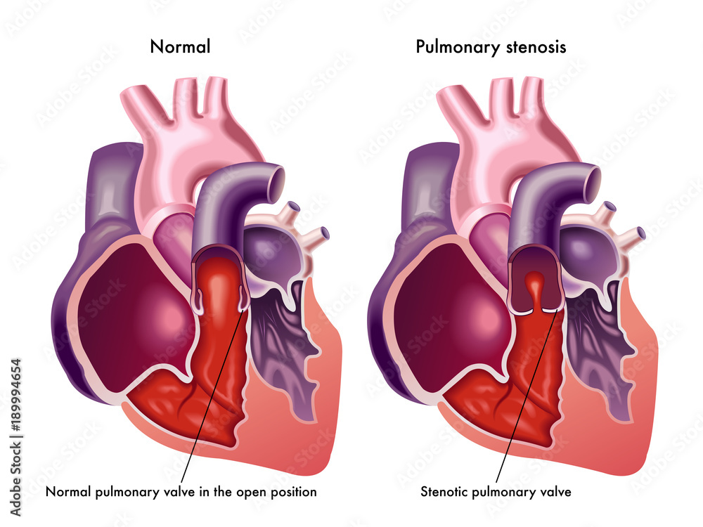 vector medical illustration of the symptoms of pulmonary stenosis Stock ...