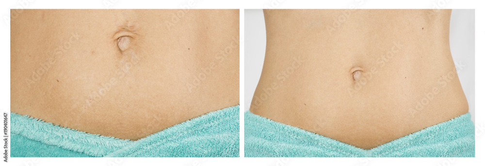 female abdomen before and after treatment of stretch marks on skin foto ...