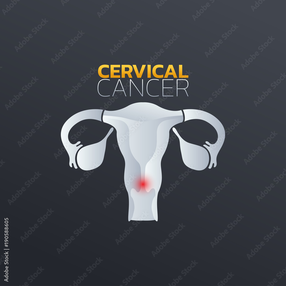 cervical cancer icon design, infographic health. Vector illustration ...