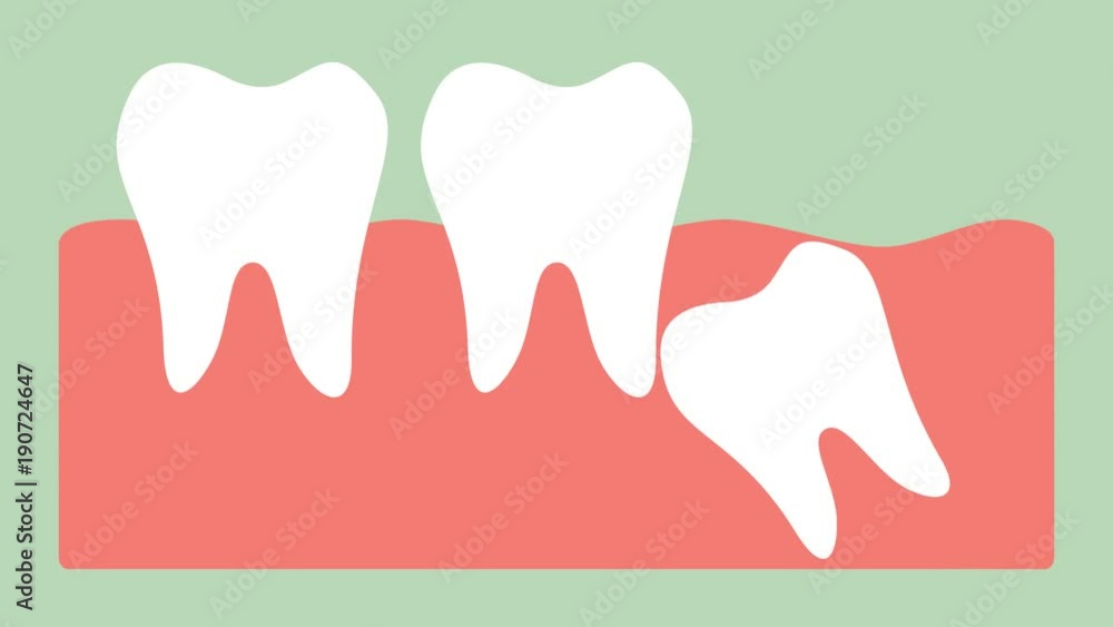 wisdom tooth ( angular or mesial impaction ) - dental cartoon vector ...