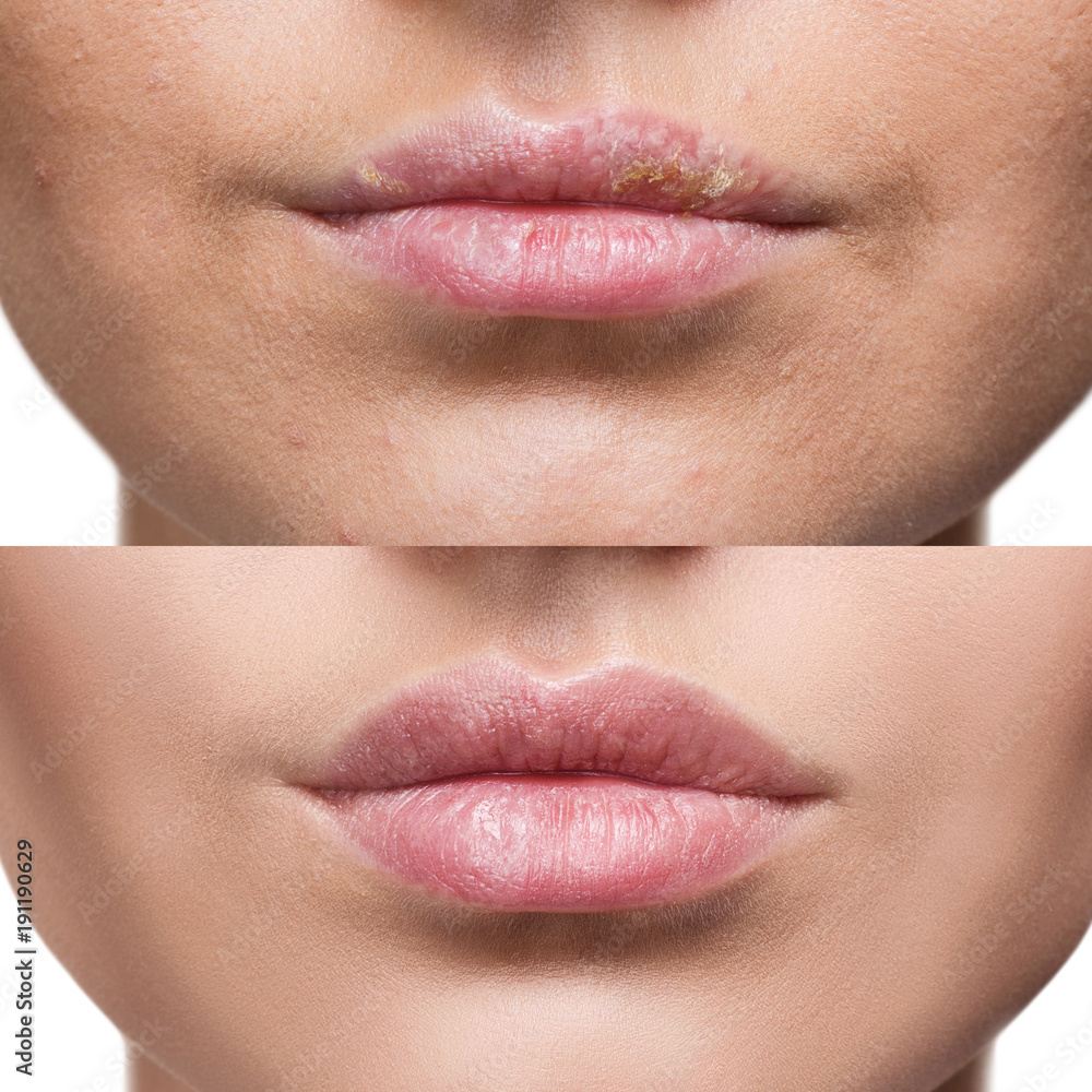 Lips with herpes before and after treatment. Stock Photo | Adobe Stock