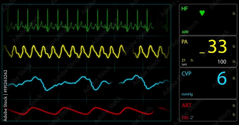 Looped: Patient monitor displays vital signs ECG electrocardiogram EKG ...