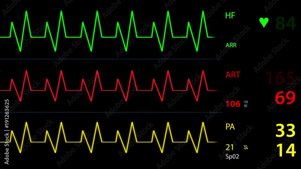 Looped: Patient monitor displays vital signs ECG electrocardiogram EKG ...