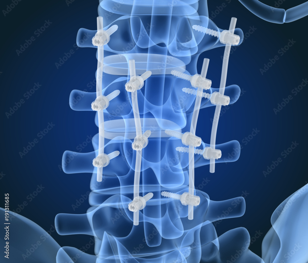 Spinal fixation system - titanium bracket. X-ray view. 3D illustration ...