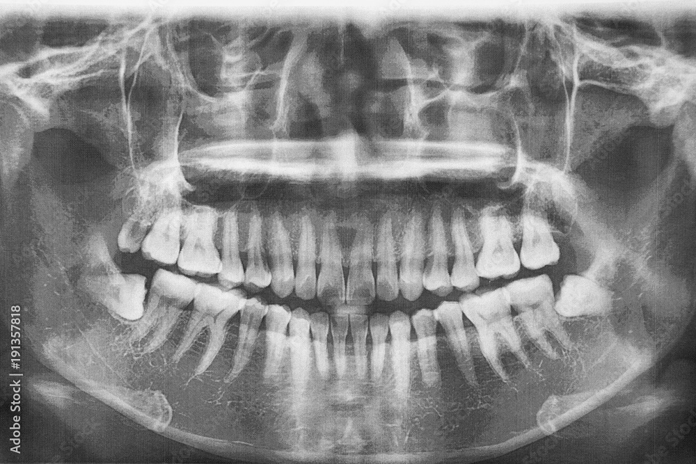X-ray film show tooth extraction on paper. Stock Photo | Adobe Stock