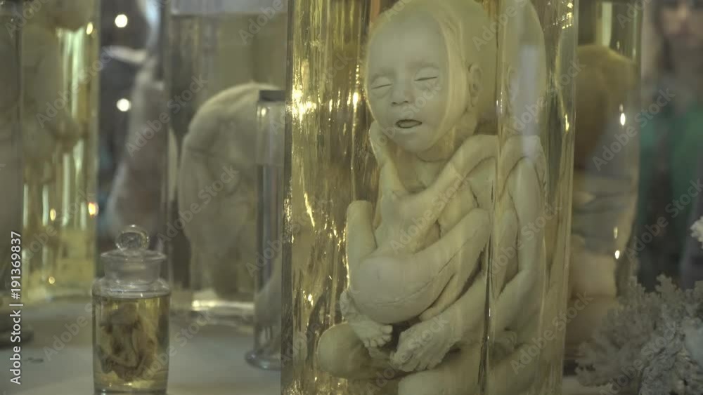 Video Stock Anatomical preserved human specimens, ugliness, anomalies ...