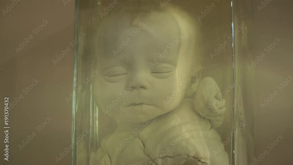 Anatomical preserved human specimens, ugliness, anomalies. Human parts ...