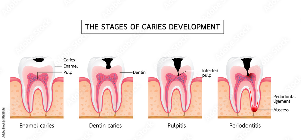 Caries Stages