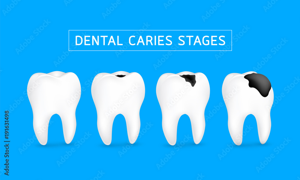 Stages of caries development. Dental care concept, illustration ...