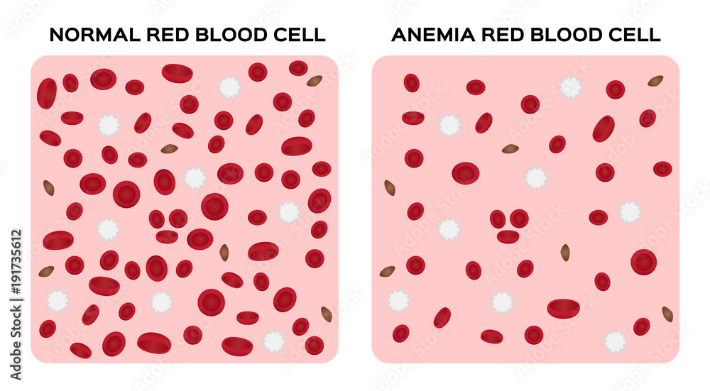anemia vector / blood anatomy concept Stock Vector | Adobe Stock