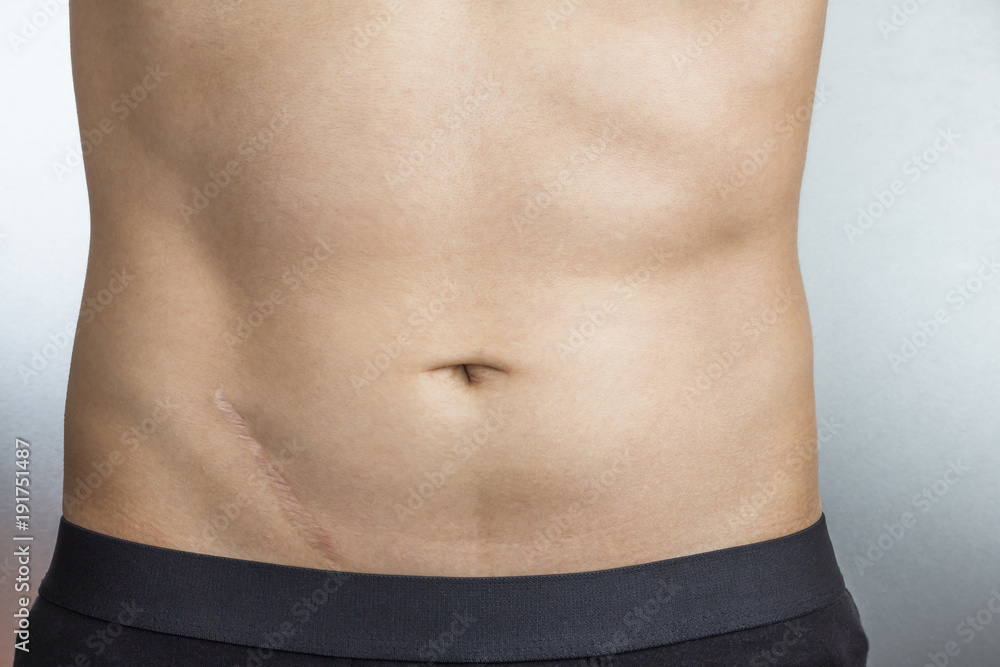 Scars removal concept. Young man with large scar after surgery on ...
