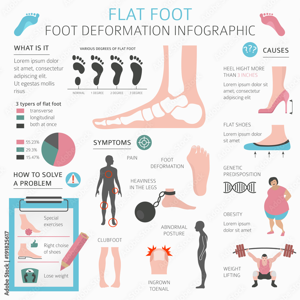 Foot deformation as medical desease infographic. Causes of Flat foot ...