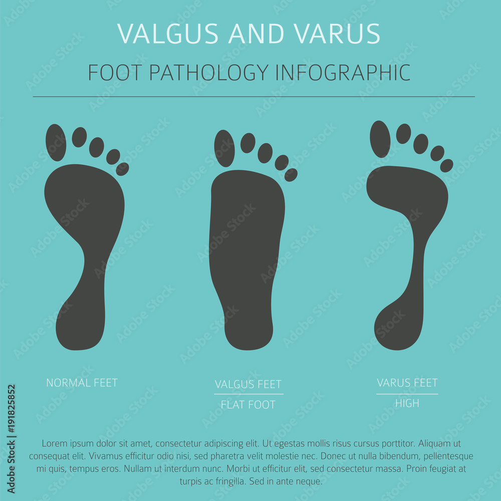 Foot deformation as medical desease infographic. Valgus and varus ...
