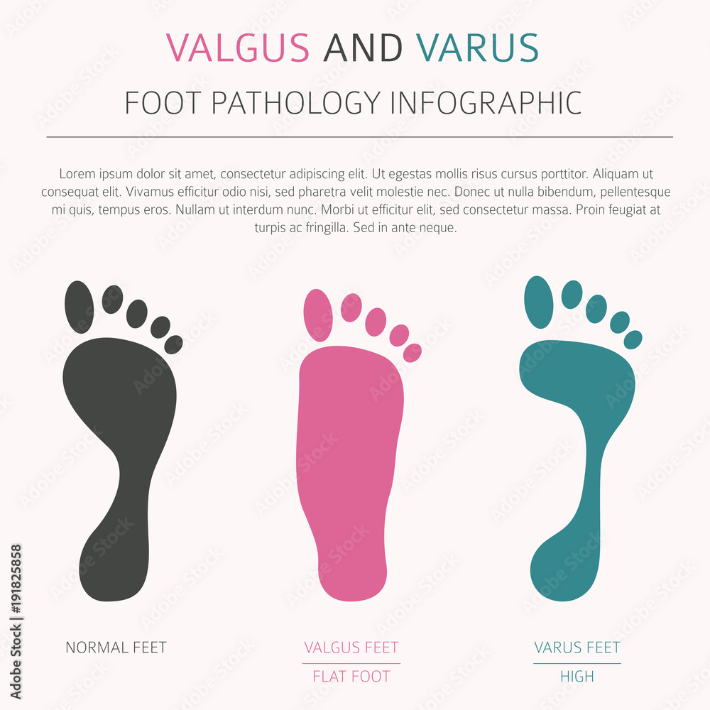 Foot deformation as medical desease infographic. Valgus and varus ...